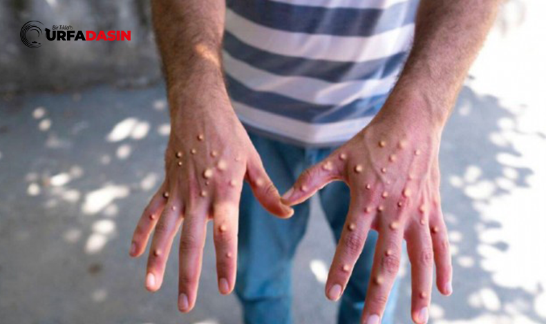 Sağlık Bakanlığından Dünyanın Gündemindeki Maymun Çiçeği Hastalığına ...